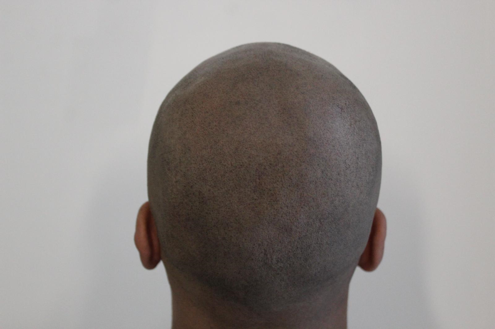 Before and after scalp micropigmentation -> Top Scalp Clinic