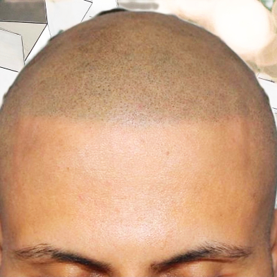 Before and after scalp micropigmentation -> Top Scalp Clinic