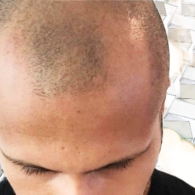 Before and after scalp micropigmentation -> Top Scalp Clinic