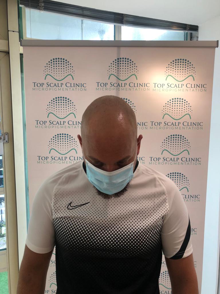 Before and after scalp micropigmentation -> Top Scalp Clinic