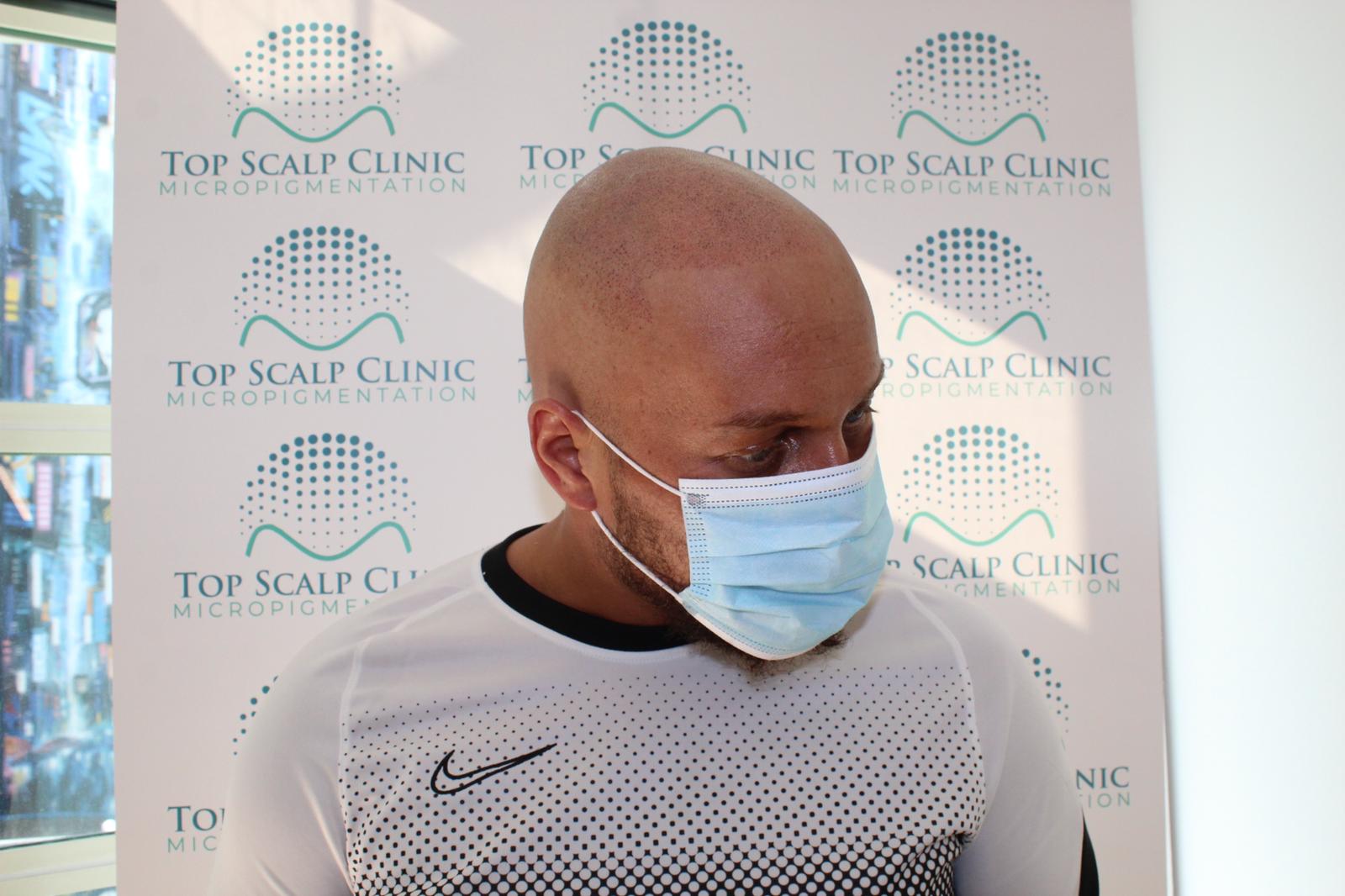 Before and after scalp micropigmentation -> Top Scalp Clinic