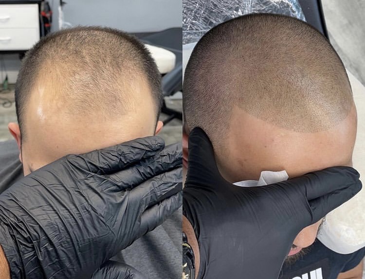 Before and after scalp micropigmentation -> Top Scalp Clinic