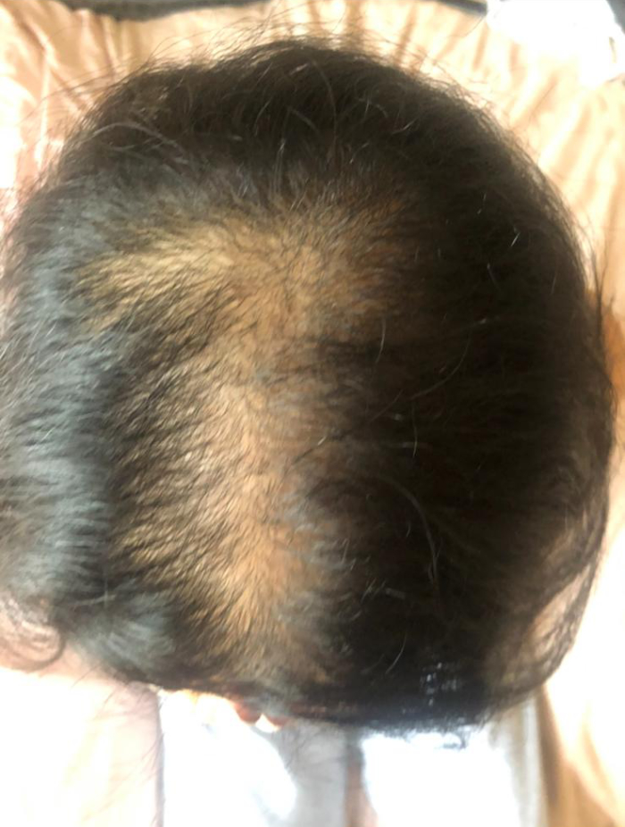 Before and after scalp micropigmentation -> Top Scalp Clinic