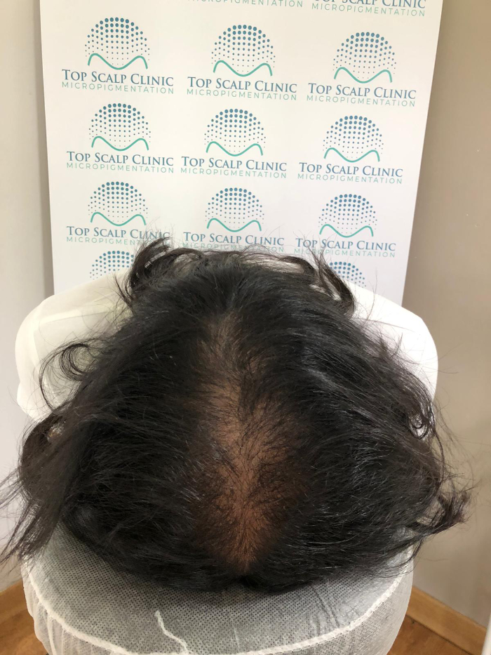 Before and after scalp micropigmentation -> Top Scalp Clinic