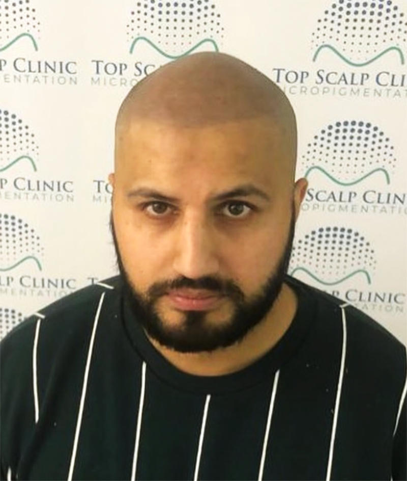 Before and after scalp micropigmentation -> Top Scalp Clinic